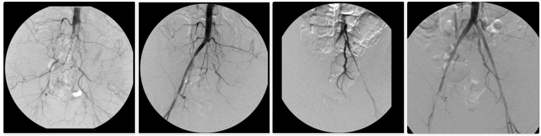 Endovascular restoration of blood flow across total occlusions of the distal aorta and bilateral ...
